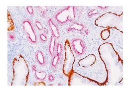 Prostate Multiplex Marker Control Slides, CK HMW+P63+AMA -Box 100 (98 ...